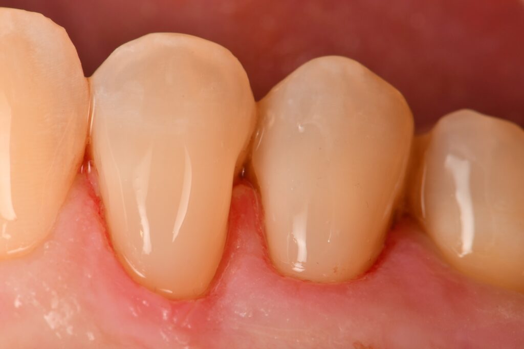 Average Value Composites for Class 5 restorations