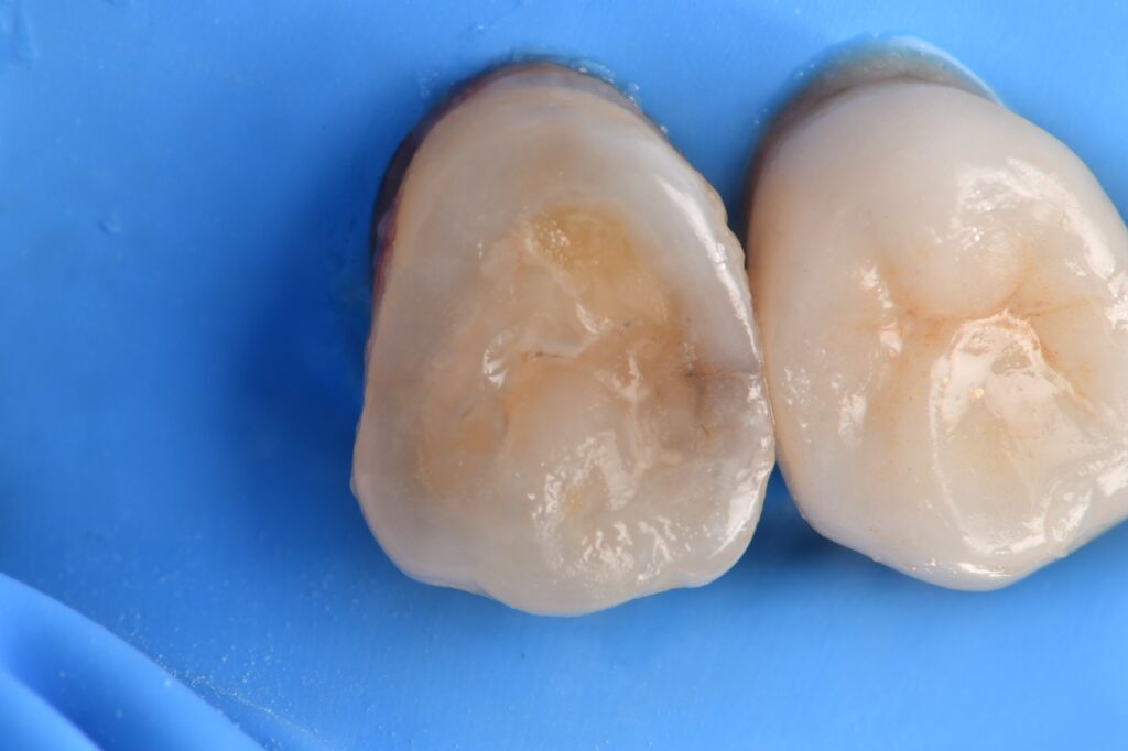 Occlusal Effect Caries due to Attrition