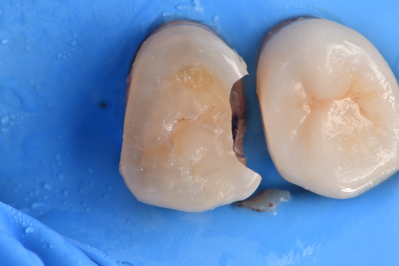 Occlusal Effect Caries due to Attrition