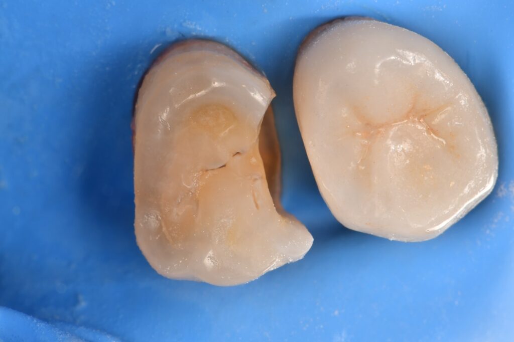 Occlusal Effect Caries due to Attrition