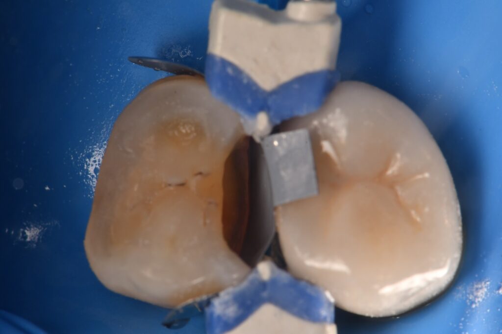 Occlusal Effect Caries due to Attrition