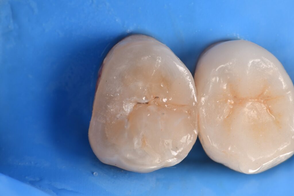 Occlusal Effect Caries due to Attrition