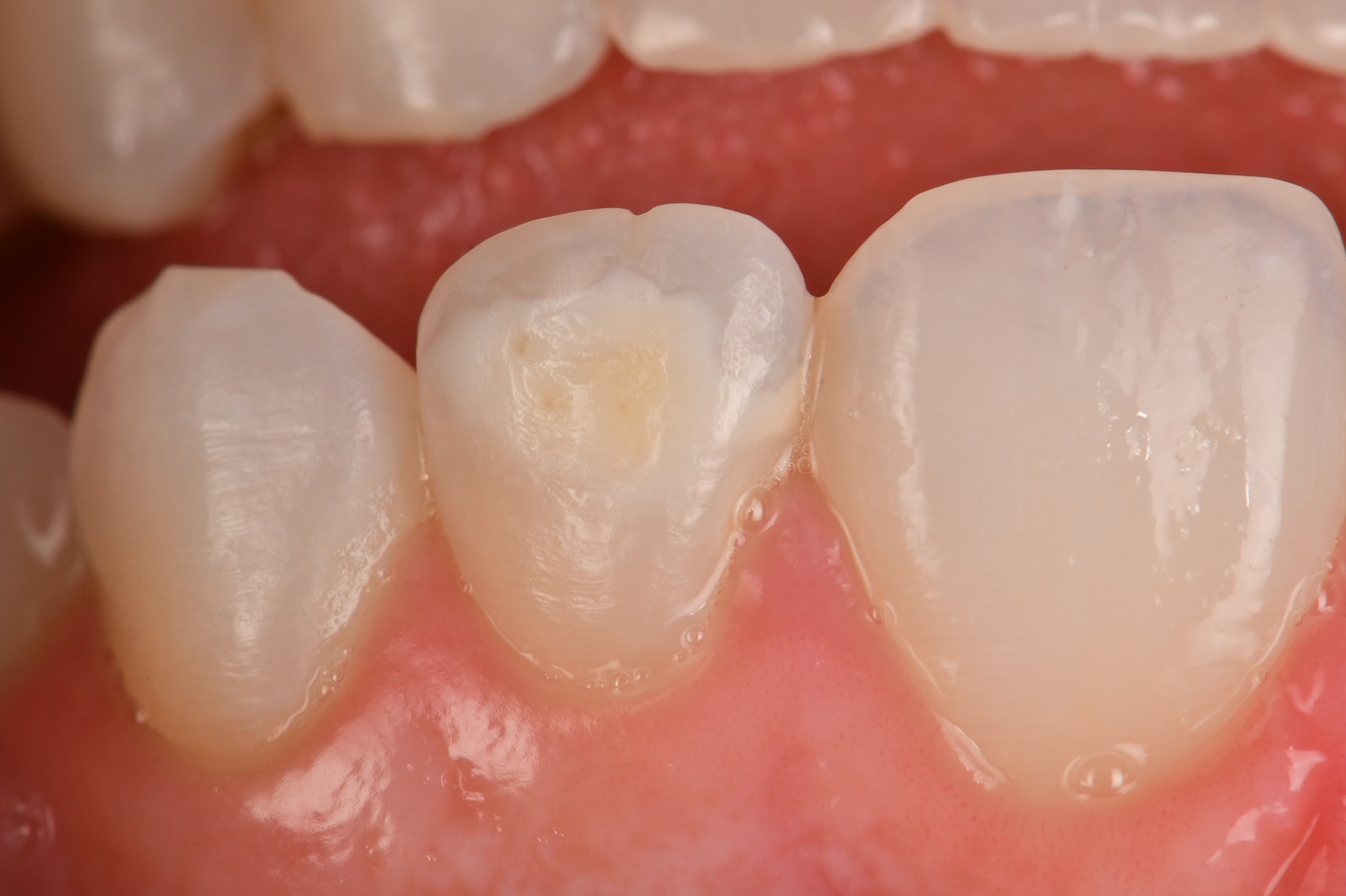 DMG Resin Infiltration used on a moderate hypomin case