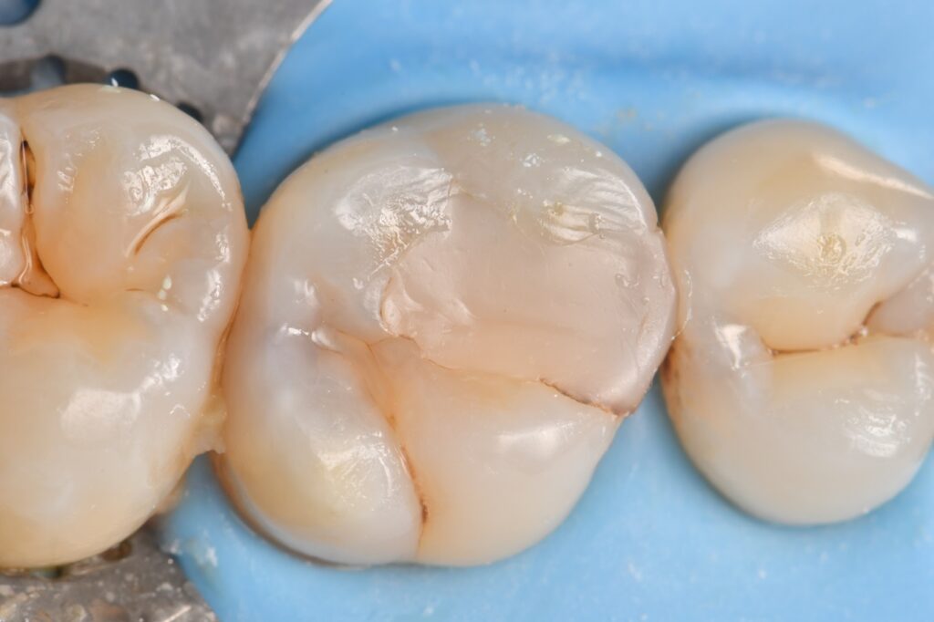 Recurrent cavities under old composite resin fillings