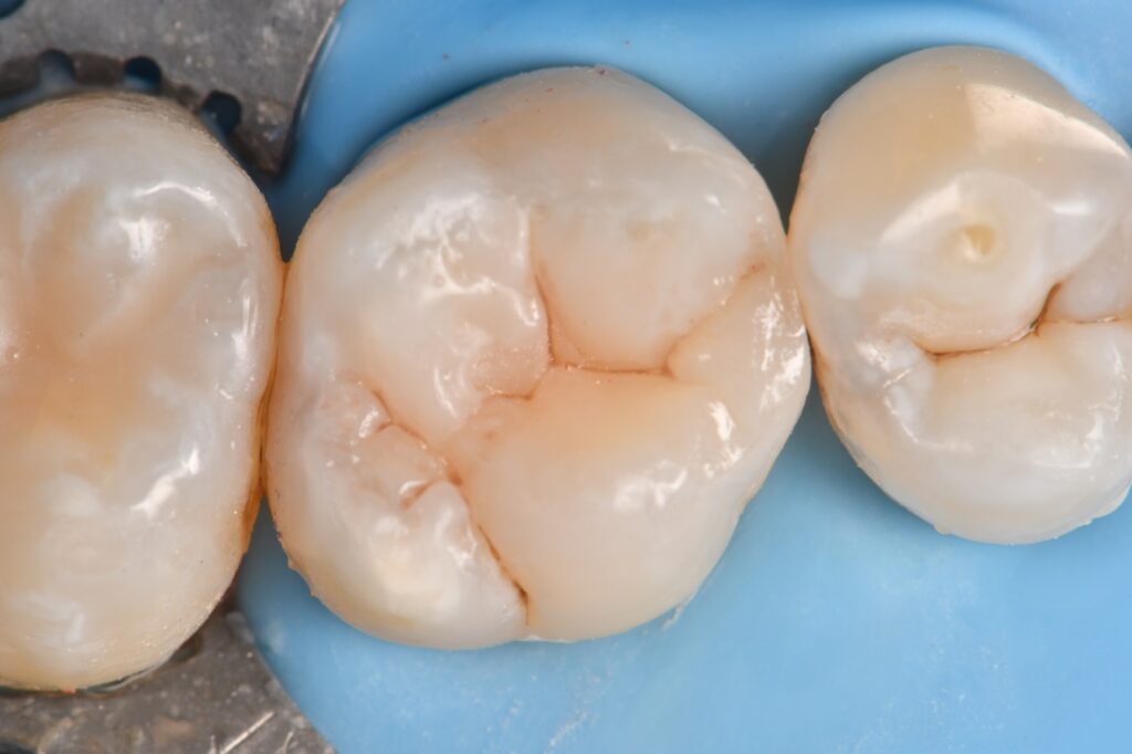 Recurrent cavities under old composite resin fillings
