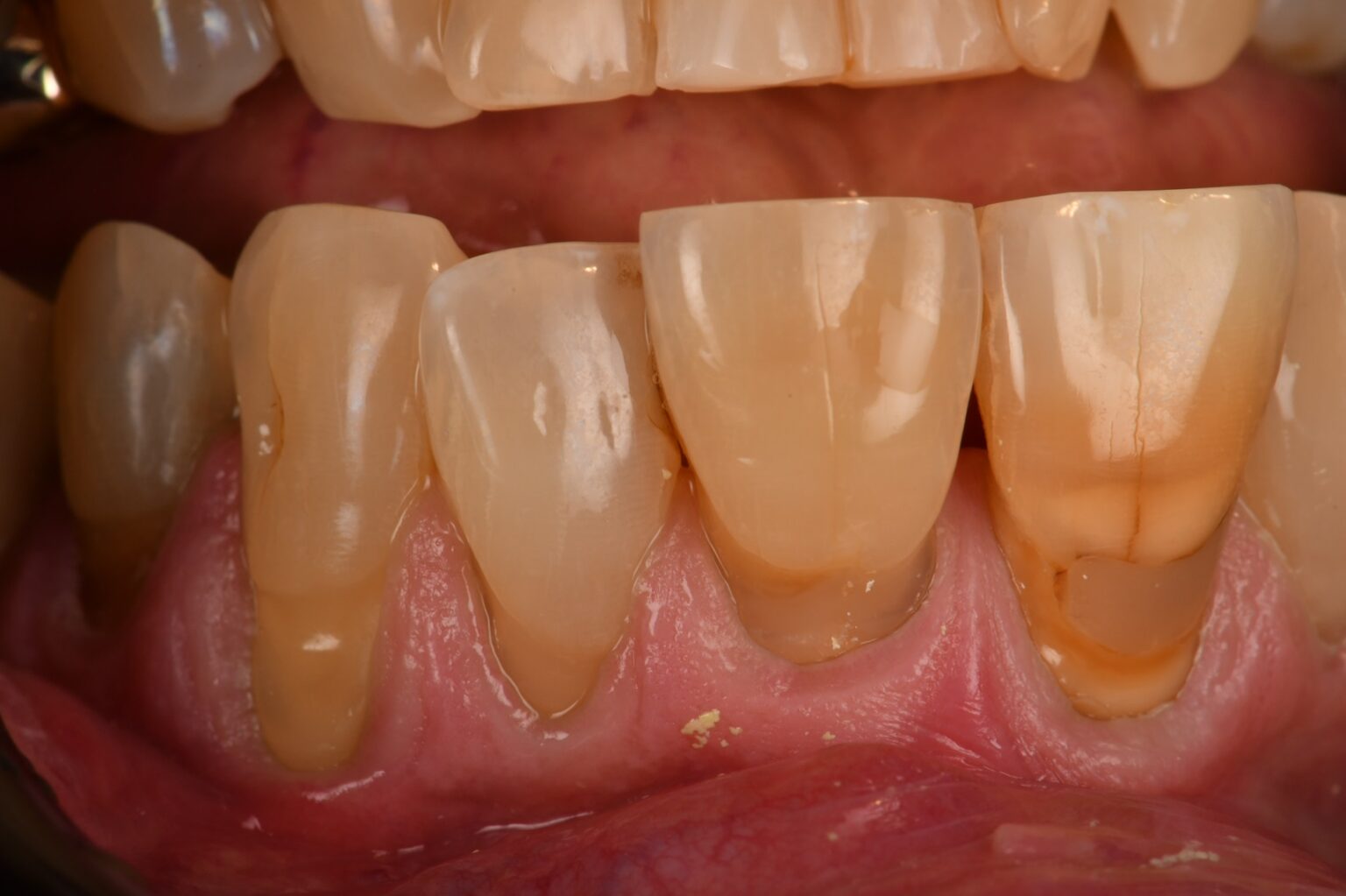 Multiple Class V lesions restored seamlessly