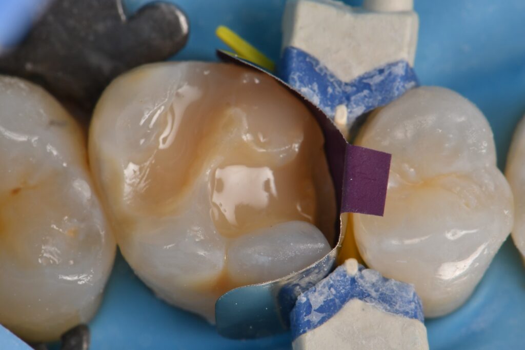 Molar Hypomineralization restored with Voco Grandio SO