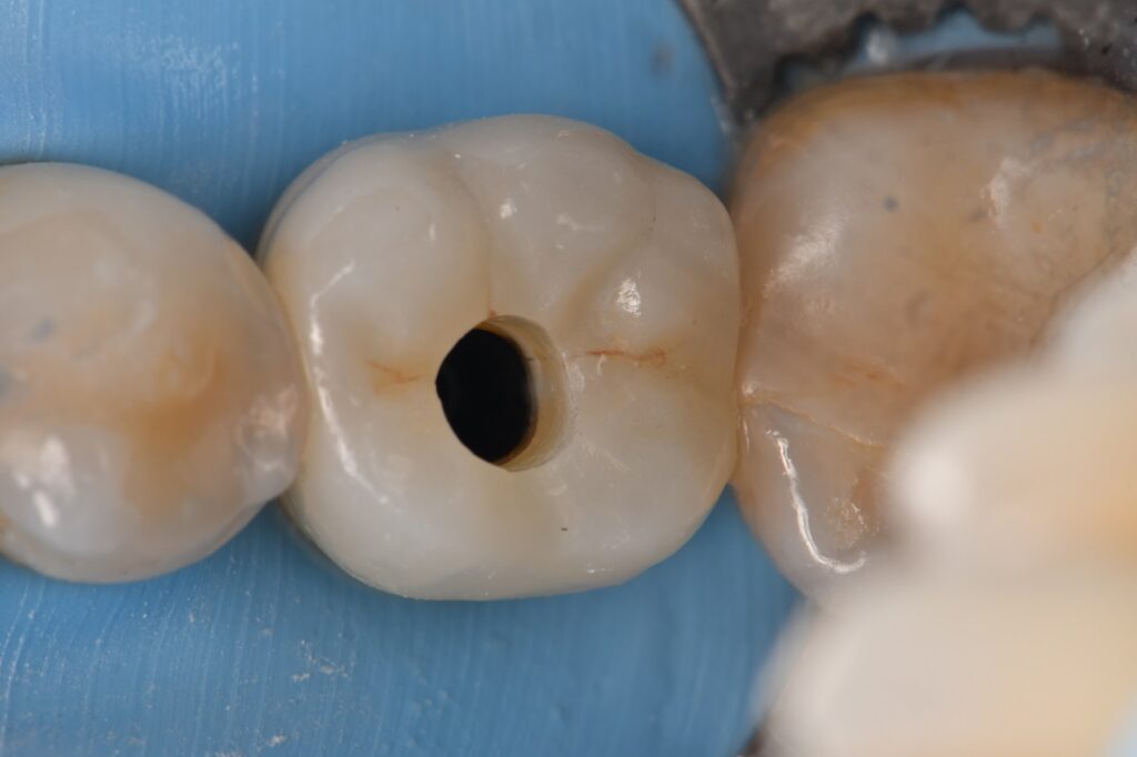 Screw Access Channel Restoration Tips