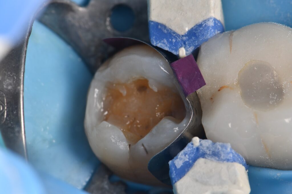 Simplishade Dark restoration crack removal restoration