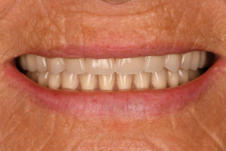 Removable Prosthodontics Complete Dentures Auckland