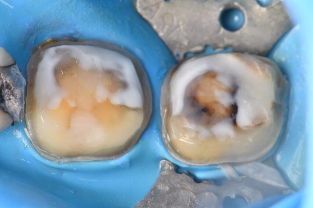 Full Coverage Ceramic Crowns for structurally compromised teeth