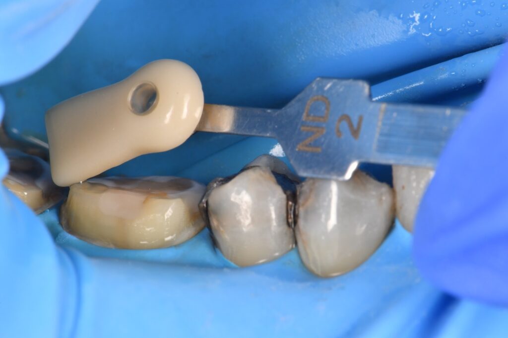 Full Coverage Ceramic Crowns for structurally compromised teeth