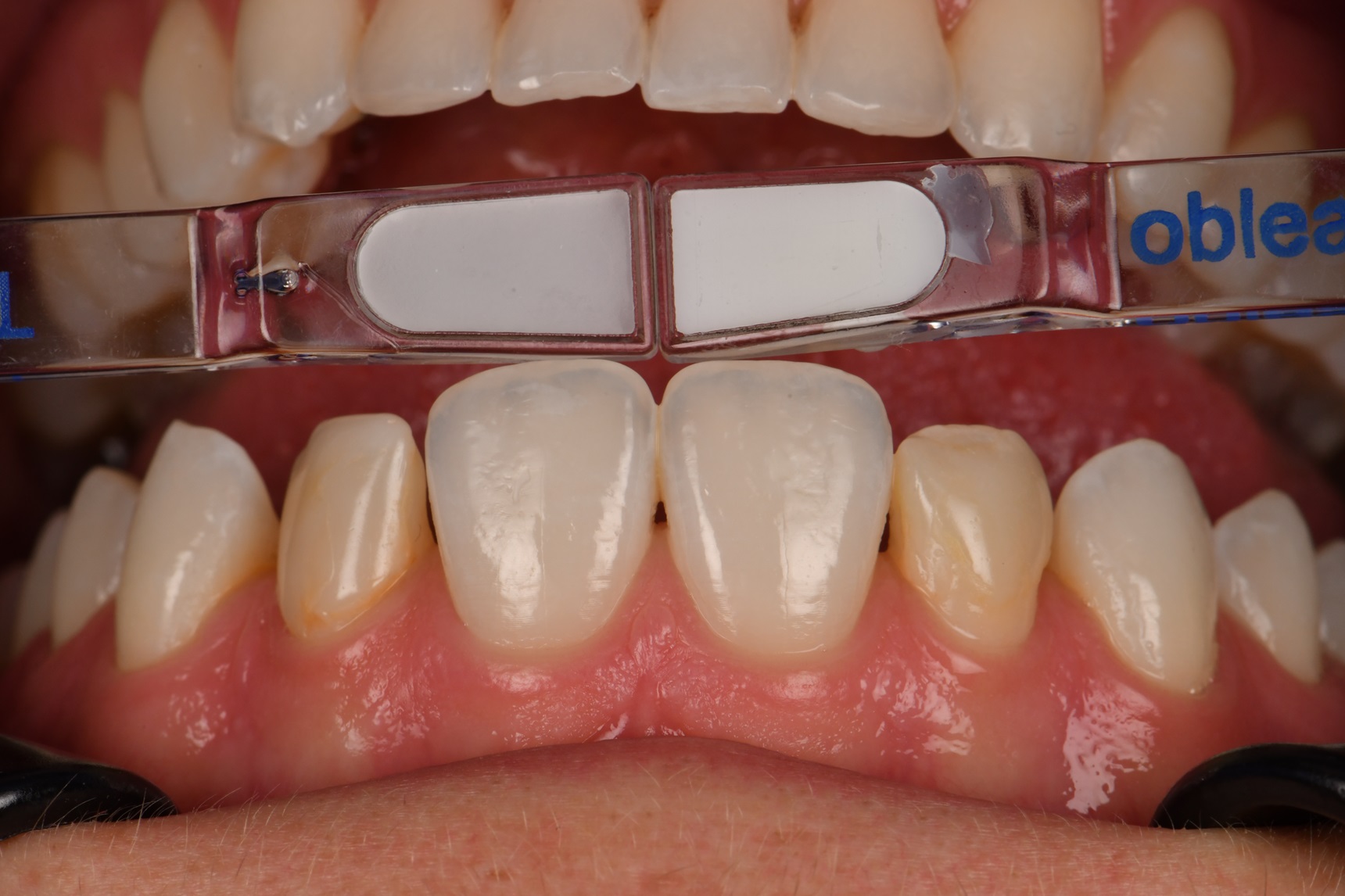 Semi-Freehand composite peg lateral restorations