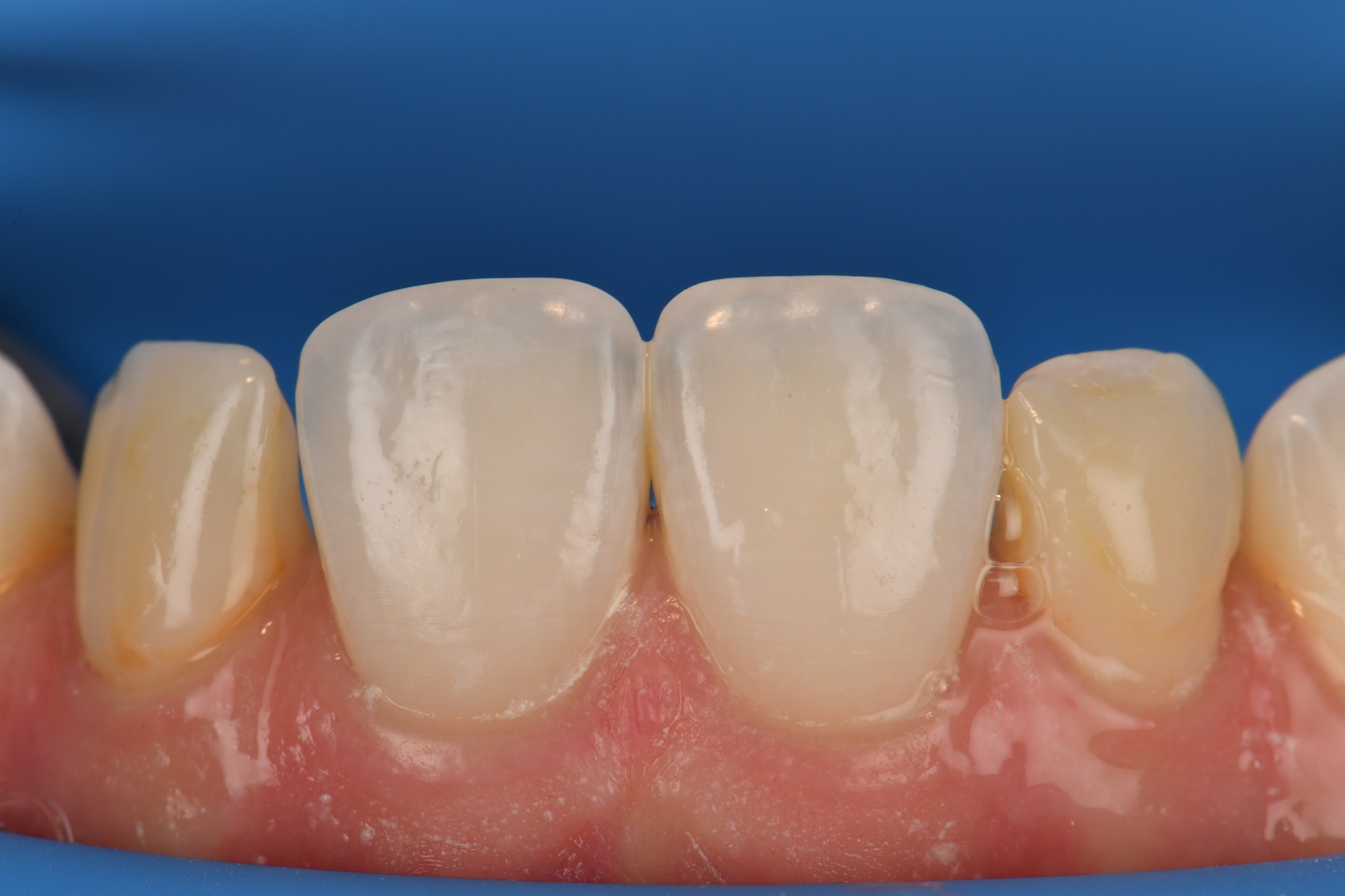 Semi-Freehand composite peg lateral restorations