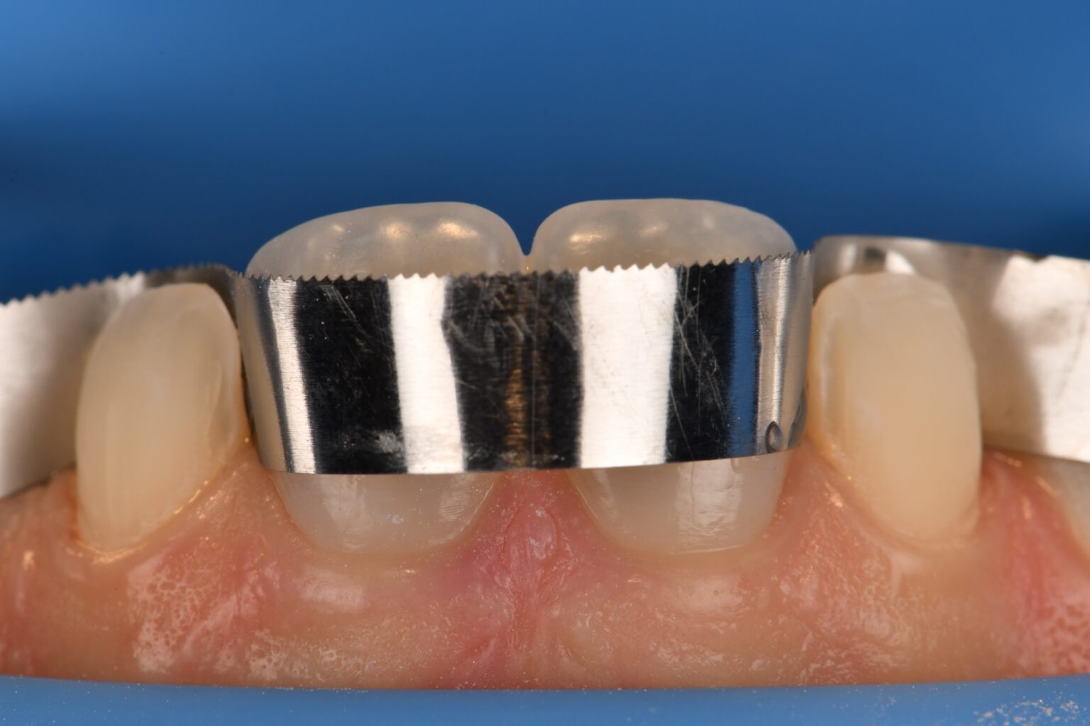 Semi-Freehand composite peg lateral restorations