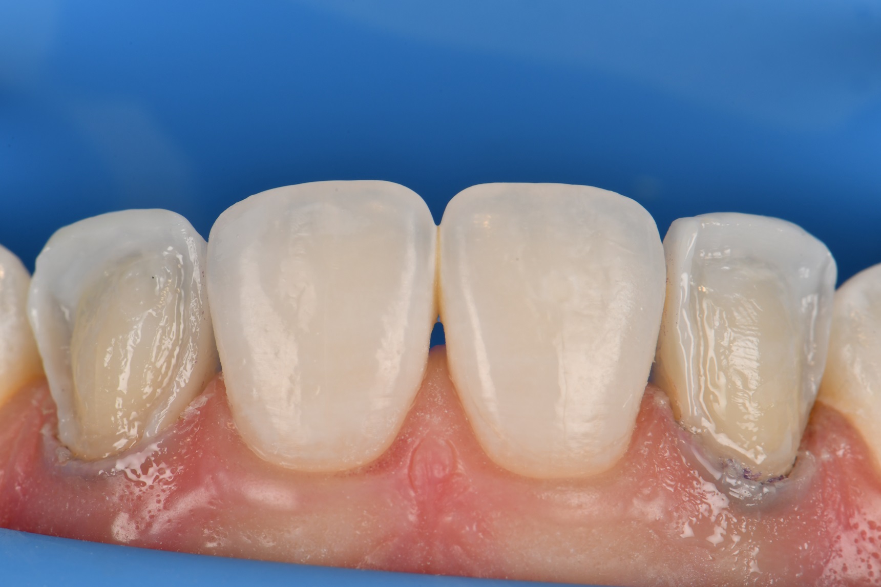 Semi-Freehand composite peg lateral restorations