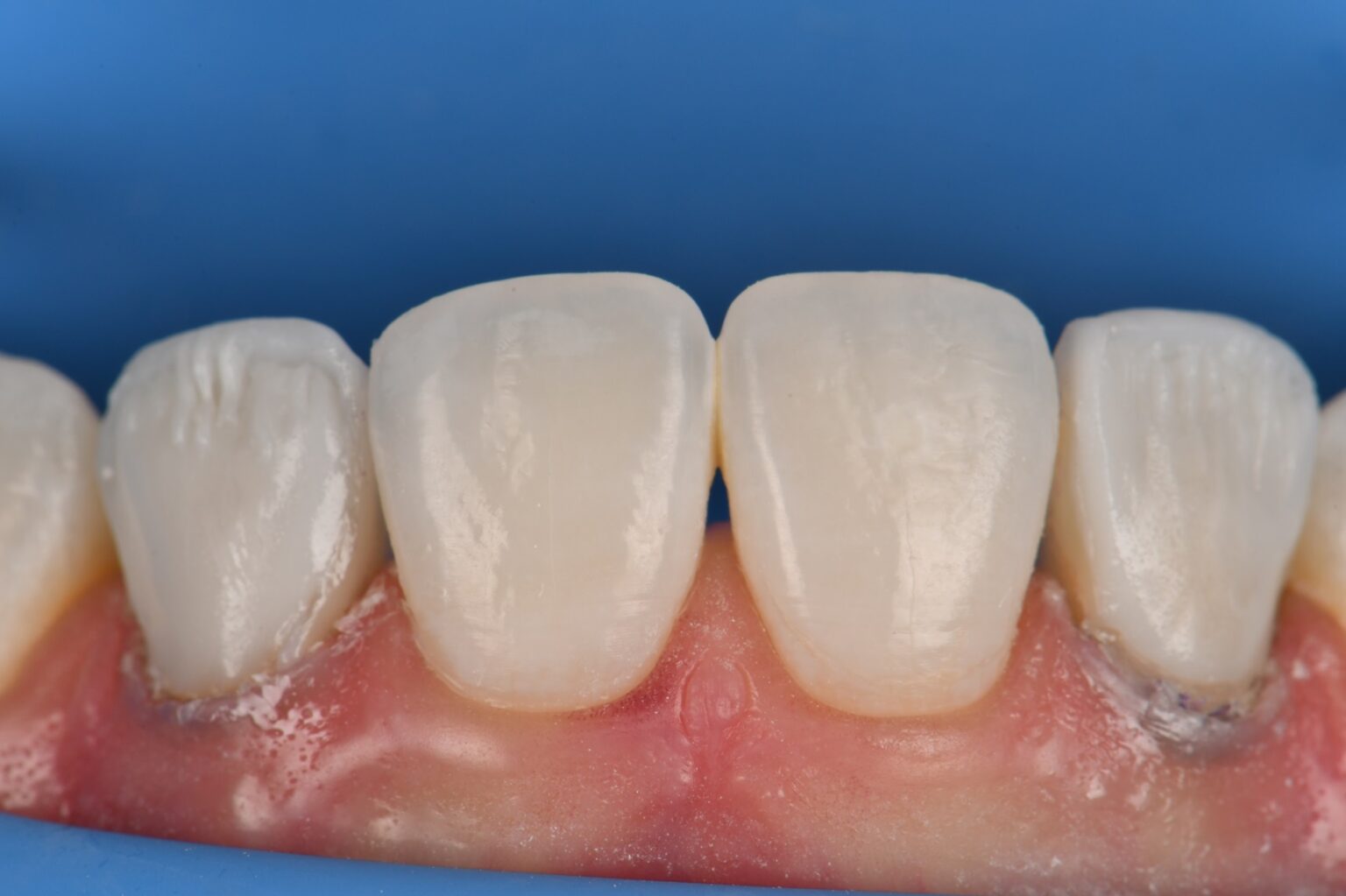 Semi-Freehand composite peg lateral restorations
