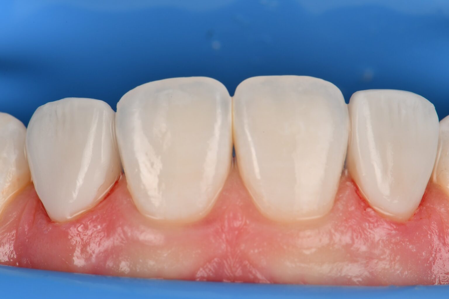 Semi-Freehand composite peg lateral restorations