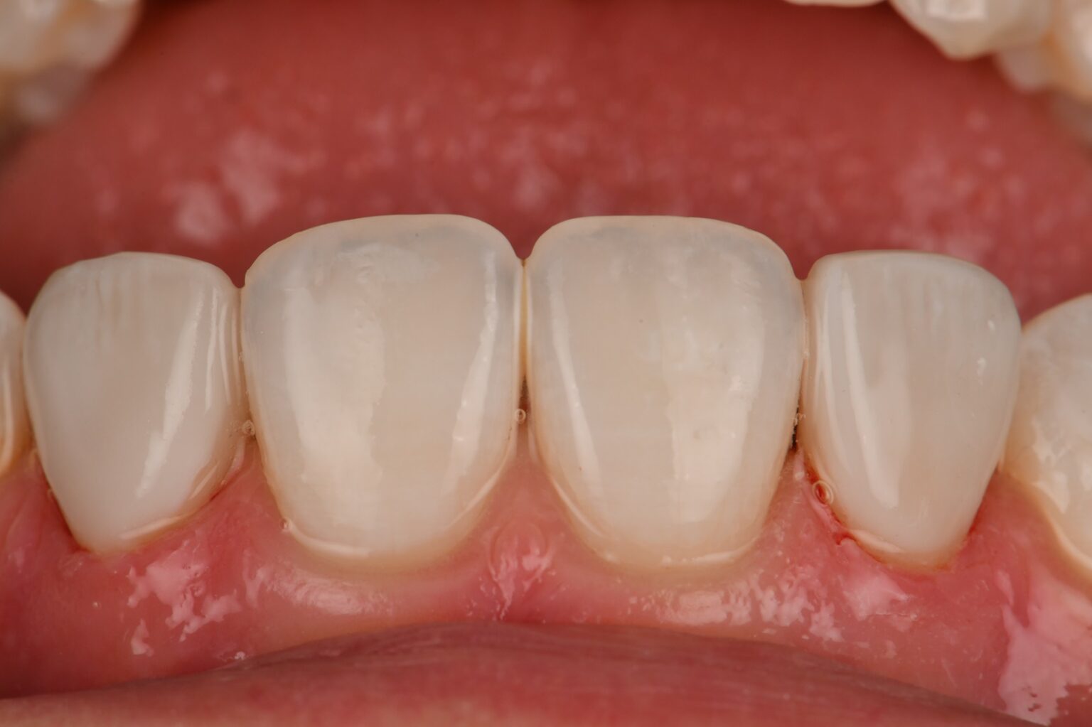 Semi-Freehand composite peg lateral restorations