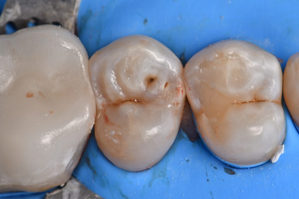 Hypomineralized enamel with deep sub fissure caries