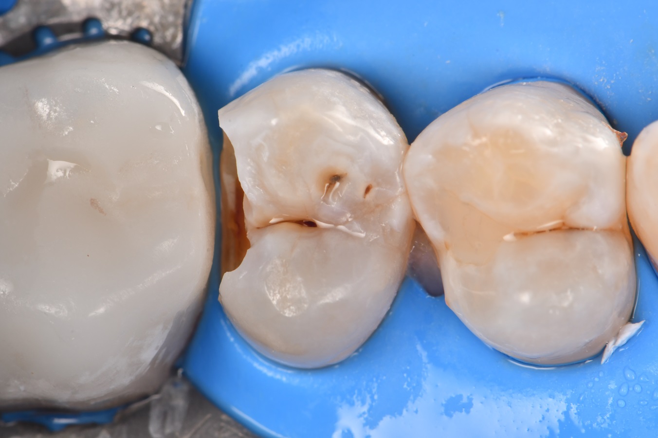 Hypomineralized enamel with deep sub fissure caries