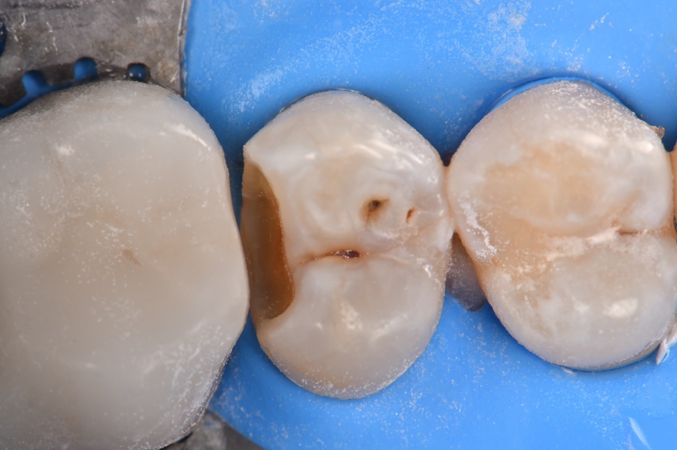 Hypomineralized enamel with deep sub fissure caries