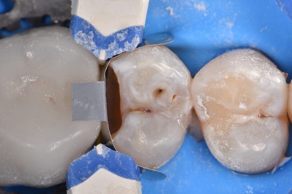 Hypomineralized enamel with deep sub fissure caries