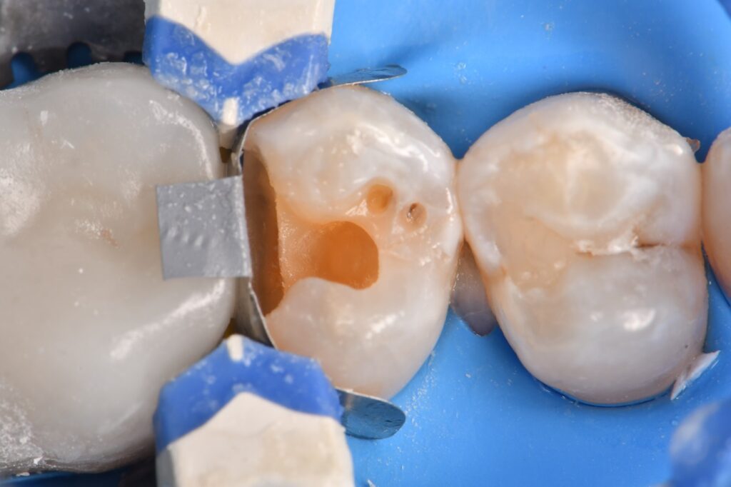 Hypomineralized enamel with deep sub fissure caries