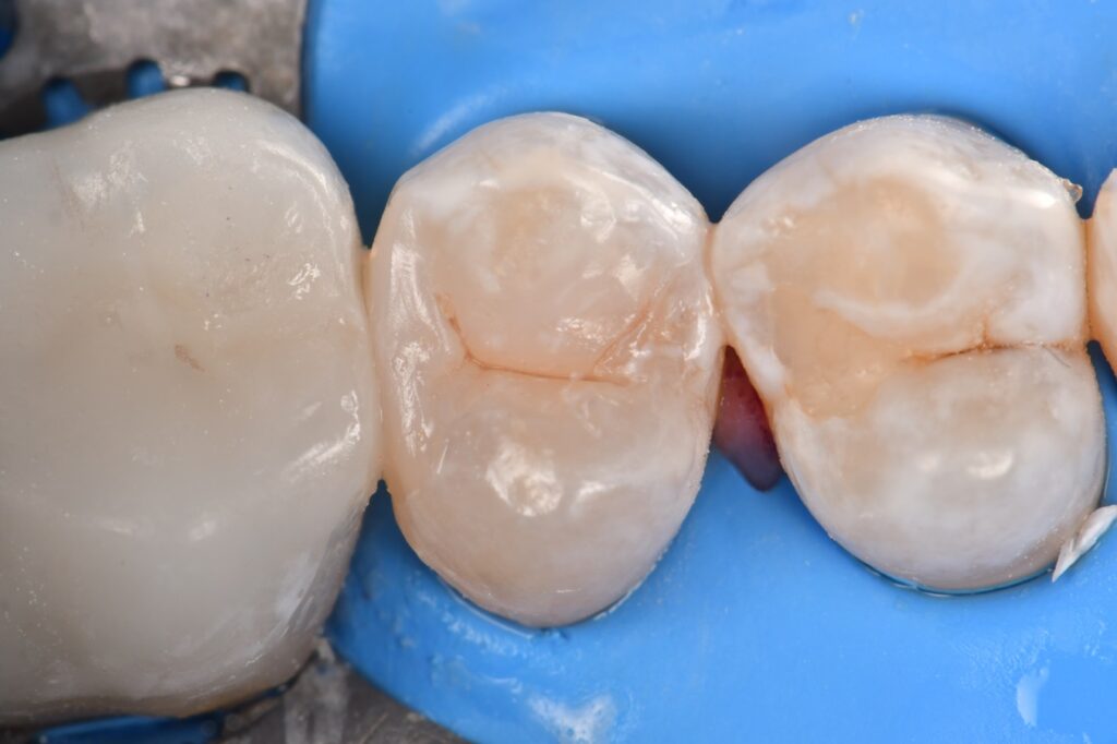 Hypomineralized enamel with deep sub fissure caries