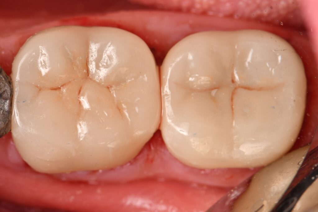 Full Coverage Ceramic Crowns for structurally compromised teeth