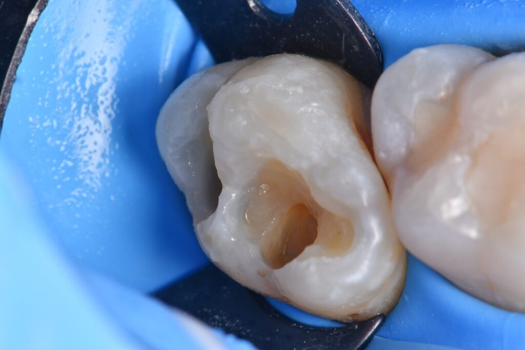 Deep recurrent caries treated with Clearfil Majesty ES-2