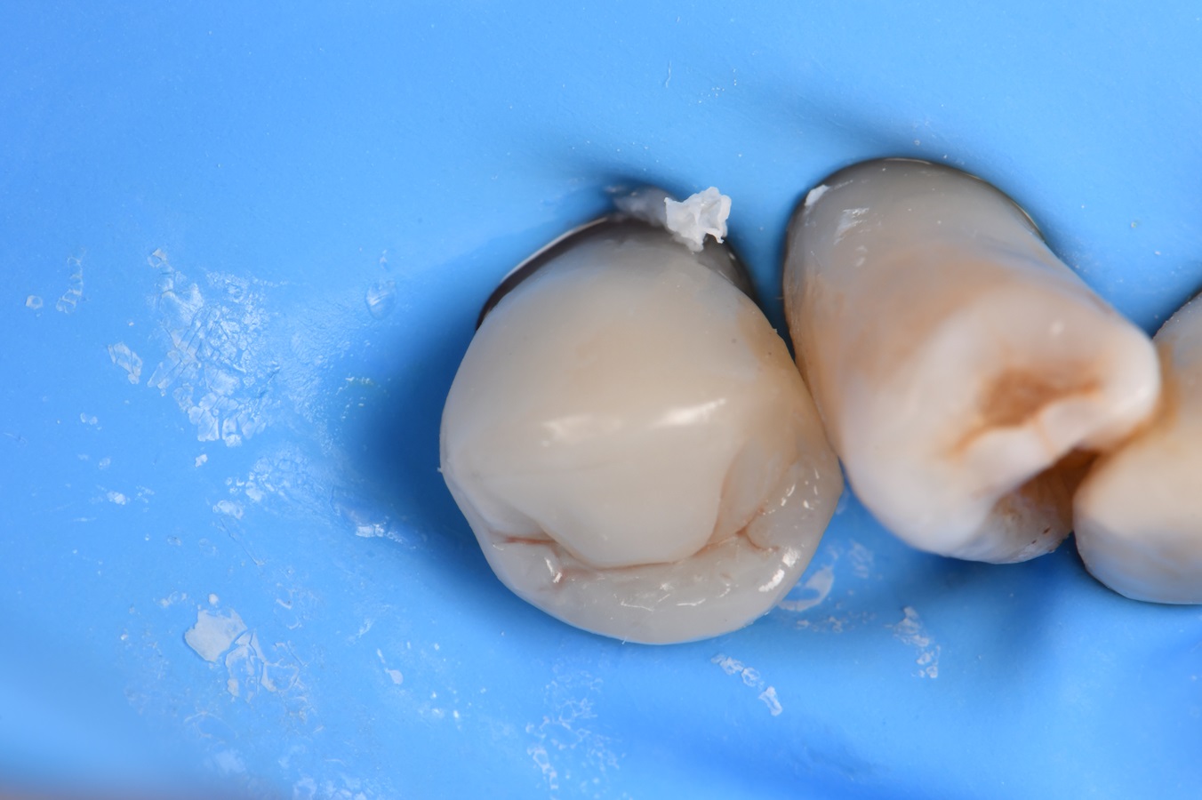 Complex premolar direct reconstruction with Voco Grandio SO supercomposite