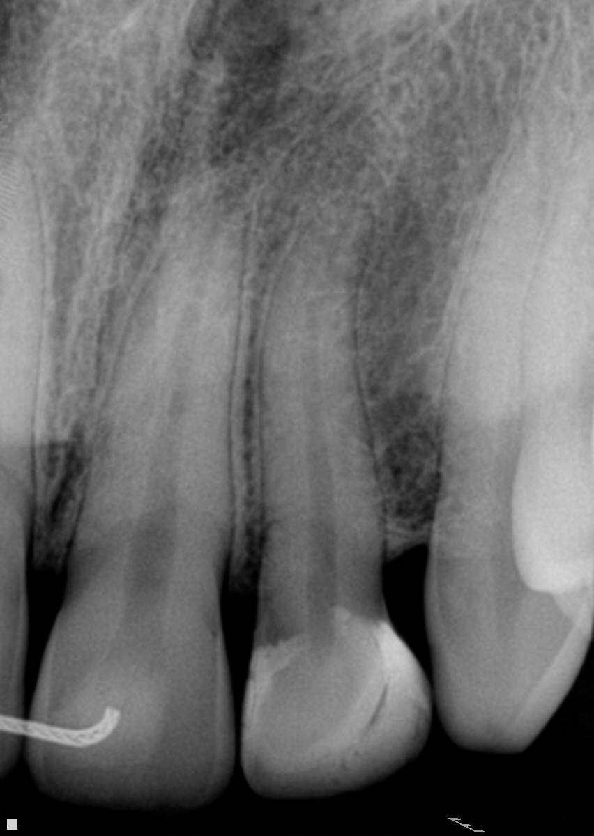 Semi-Freehand composite peg lateral restorations