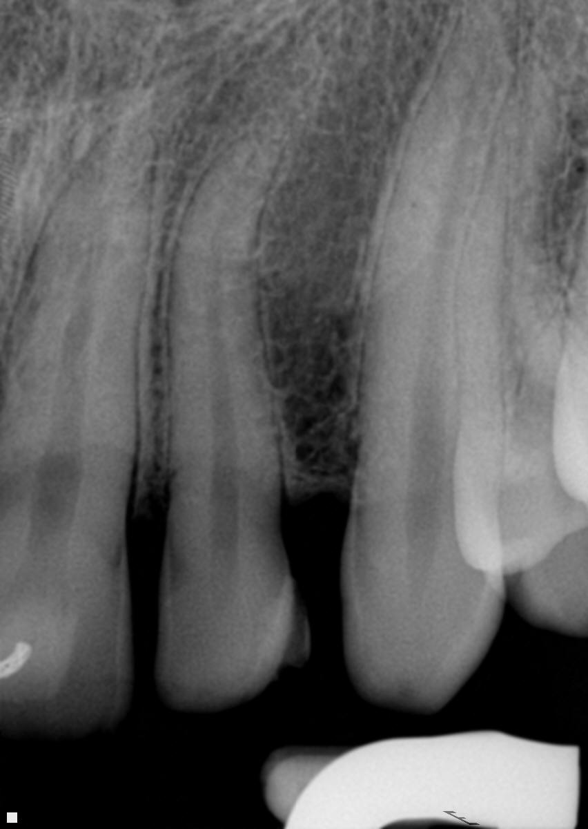 Semi-Freehand composite peg lateral restorations