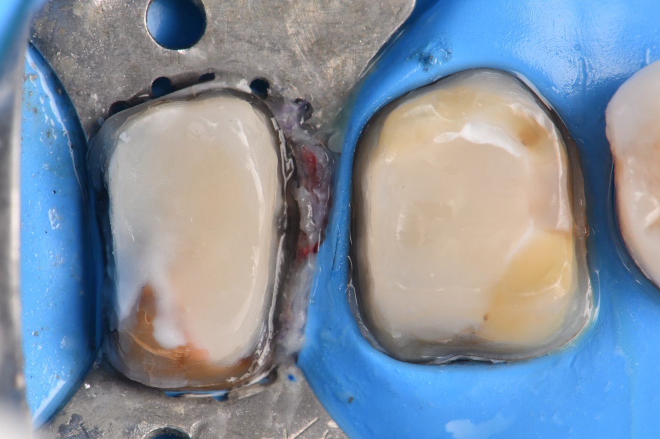 Complex Reconstruction on Molars