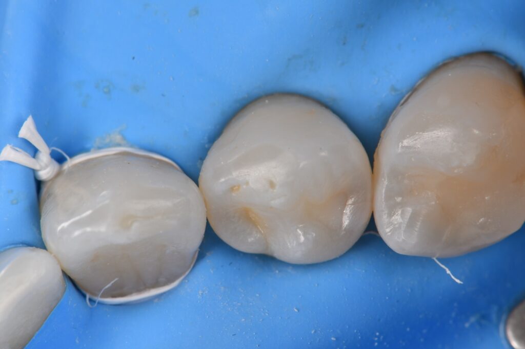 Class II caries restored with direct chameleon composite resin