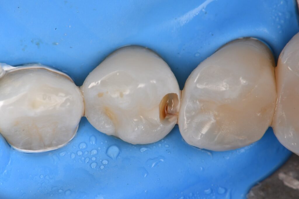 Class II caries restored with direct chameleon composite resin