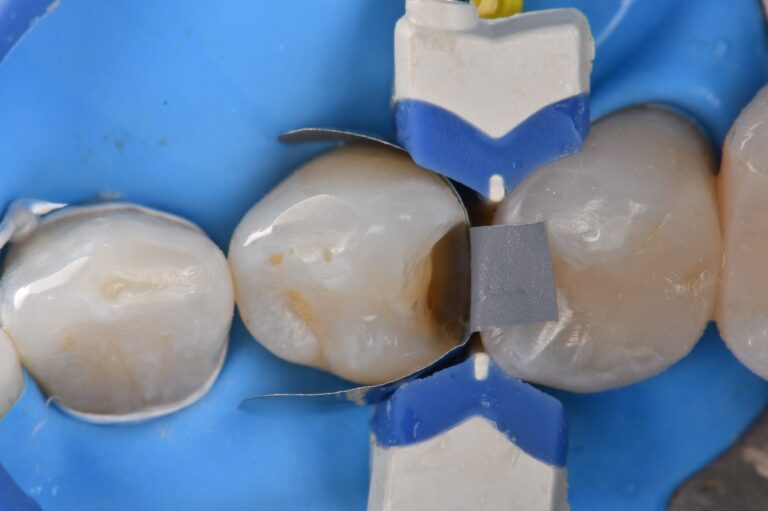 Class II caries restored with direct chameleon composite resin