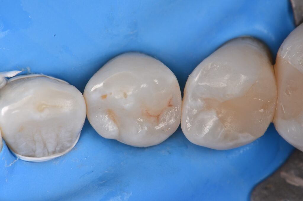 Class II caries restored with direct chameleon composite resin