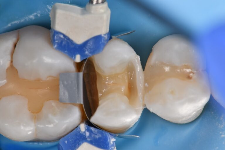 Composite replacement due to marginal leakage