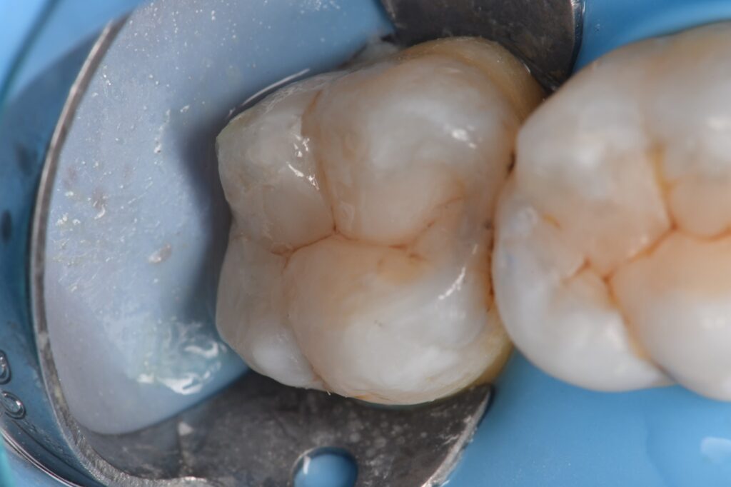 Class I restoration replacement on tooth #15