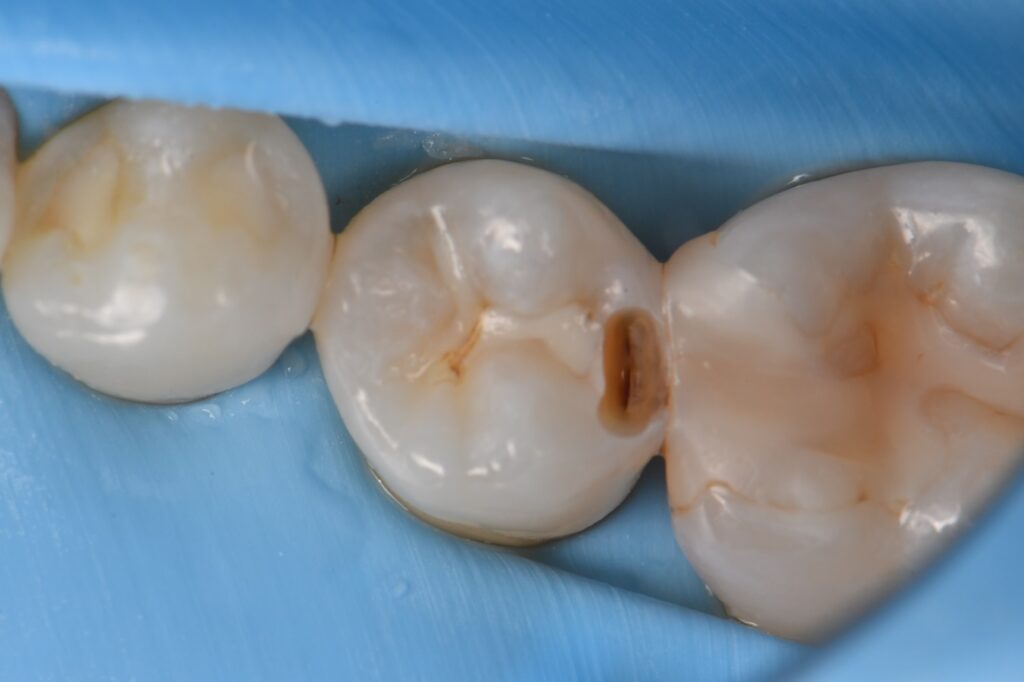 Recontouring an adjacent restoration to idealize contact point anatomy
