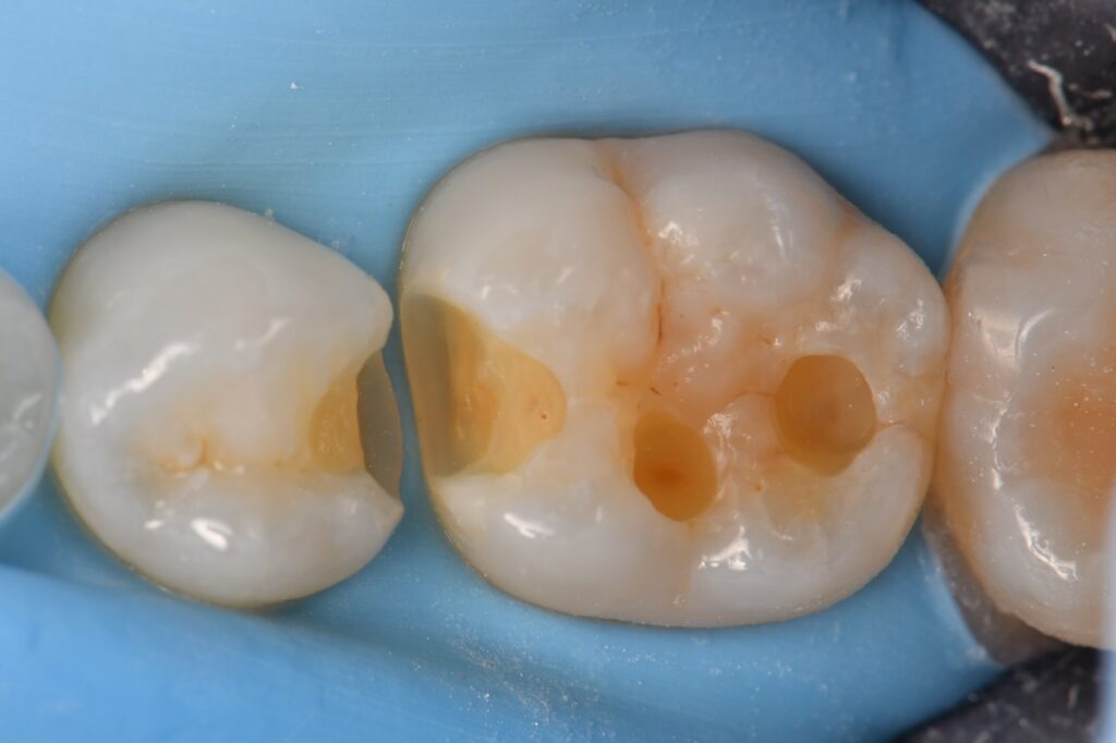 Back to back composite restorations