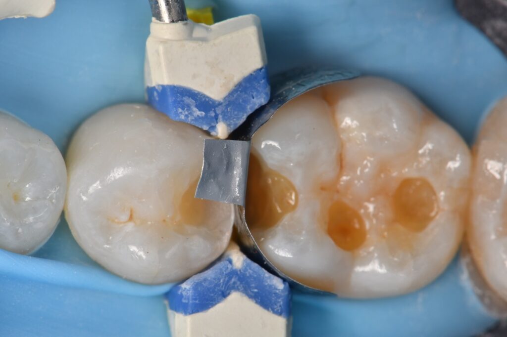 Back to back composite restorations
