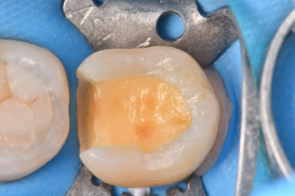 Class II Direct Composite with Garrison Compositight