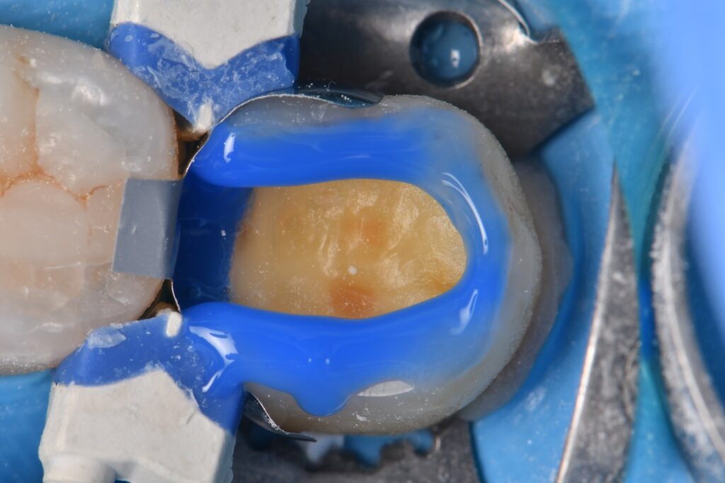 Class II Direct Composite with Garrison Compositight