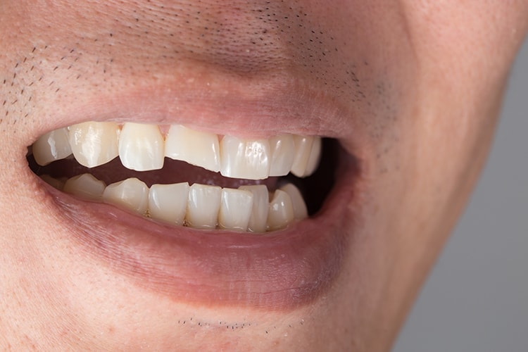 How to Fix a Damaged Tooth