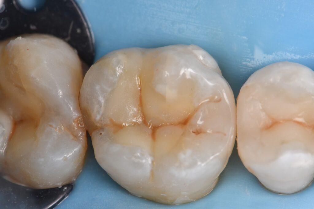 Optimizing Proximal Axial Contours with Garrison