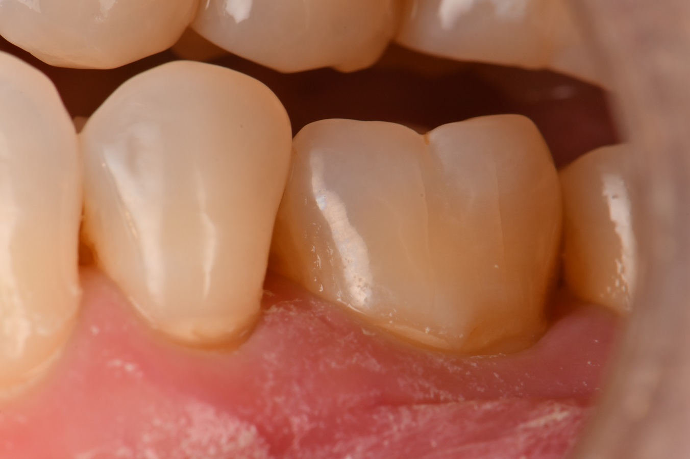 Class V cervical abrasion lesions deep