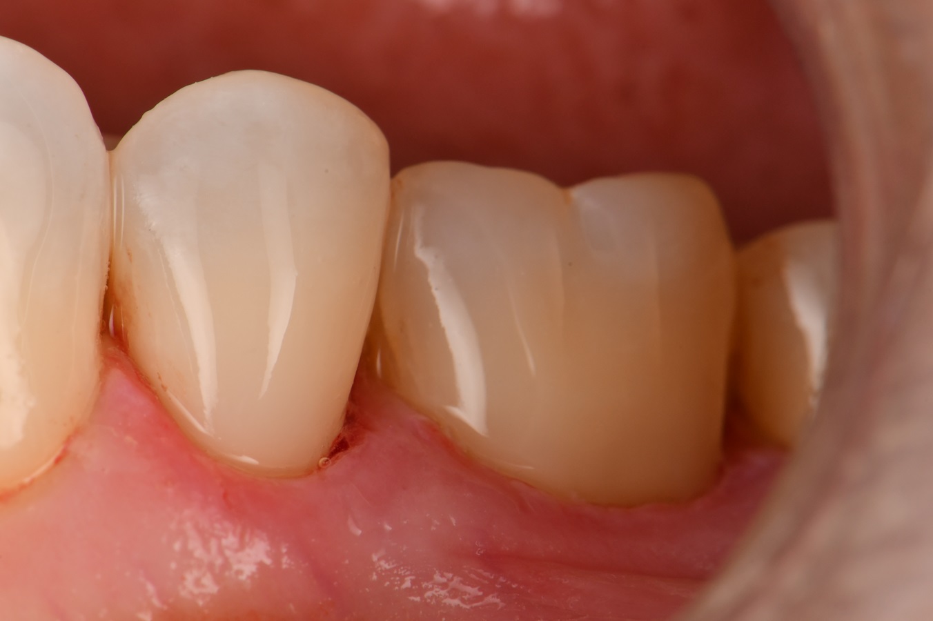 Class V cervical abrasion lesions deep